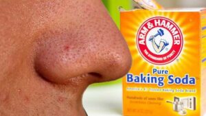 Sebaceous Filaments on Nose, Removal, How to Get Rid, Treatment to ...