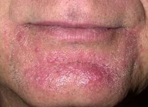 How to Get Rid of Razor Burn Fast, Quickly on Legs, Bikini, Face, Treat ...