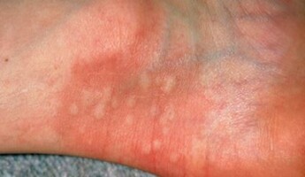 White Bumps on Legs: Small, Itchy, Hard Raised Spots on Legs after ...