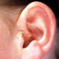 Scab in Ear Canal that Won’t Go Away, on Lobe, Hurts, Piercing, Behind ...
