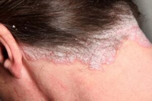 Scabs on Scalp: Causes, Treatment & Remedies | Treat, Cure Fast