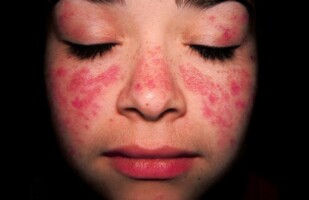 Rash Under Breast Pictures, Get Rid of Sore Heat Rash from Sweat ...