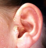 Dry Skin in Ears, Inside Ear Canal, Itchy, Flaky Skin Behind Ears ...