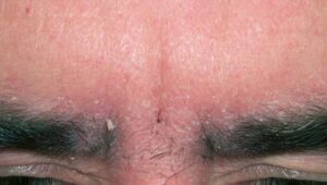 Itchy Eyebrows Meaning, Dry Flaky Eyebrows, Hair Loss and Eyebrows ...
