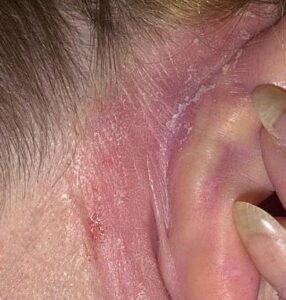 Itchy Ears, Canal, Inner Ear Itching, Lobe, Causes, Meaning, Allergies ...