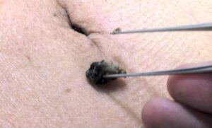 Itchy Belly Button Causes, Red Itching Navel After Surgery, Yeast ...