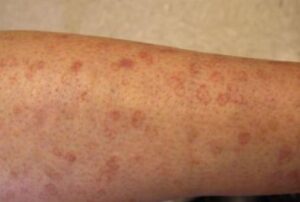 Brown Spots on Legs, Lower Legs, Get Rid of Little Light Brown Dots on ...