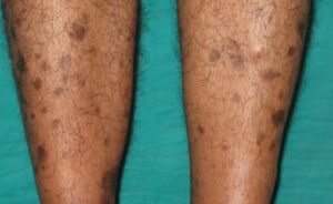 Brown Spots on Legs, Lower Legs, Get Rid of Little Light Brown Dots on ...