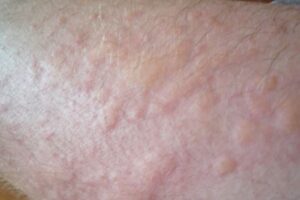 Heat Lumps on Legs, Skin, Pictures, Causes, Treatment