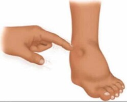 Anasarca Meaning, Definition, Pictures, Causes, Treatment, Scrotal ...