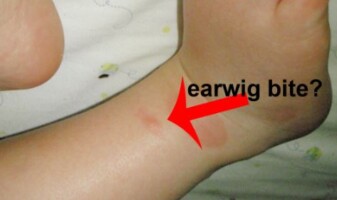 Earwig Bite Symptoms, Pictures, Treatment, Marks, Bites on Humans, Ears