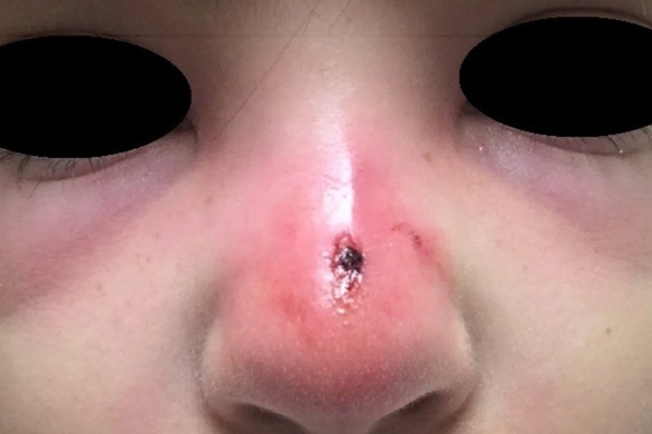 Bad Smell in Nose, Mucus, Why, Causes, Stuffy, Sinus After Rhinoplasty ...