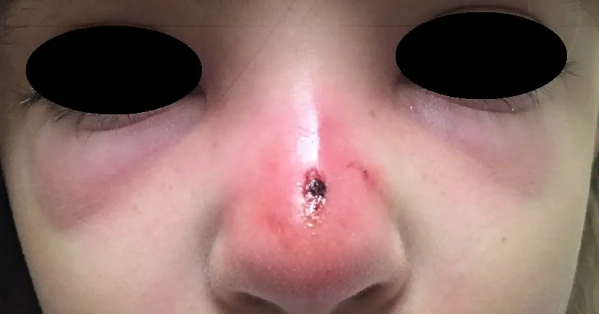 Scabs In The Nose - Symptoms, Causes, And Treatments! | Treat, Cure Fast