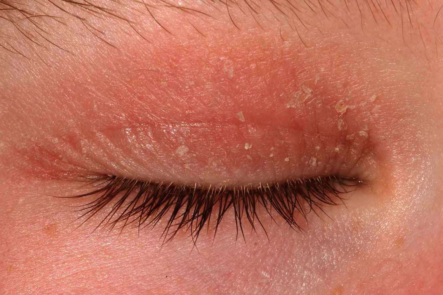Understanding Eyelid Dermatitis: Causes, Symptoms, and Effective ...